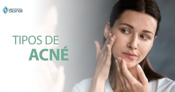 7 Tipos De Acné Y Sus Características - LABORATORIOS SOREL
