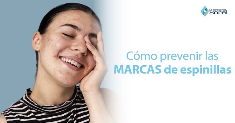 ¿Qué Son Las Marcas De Espinillas Y Cómo Prevenirlas? | 2026